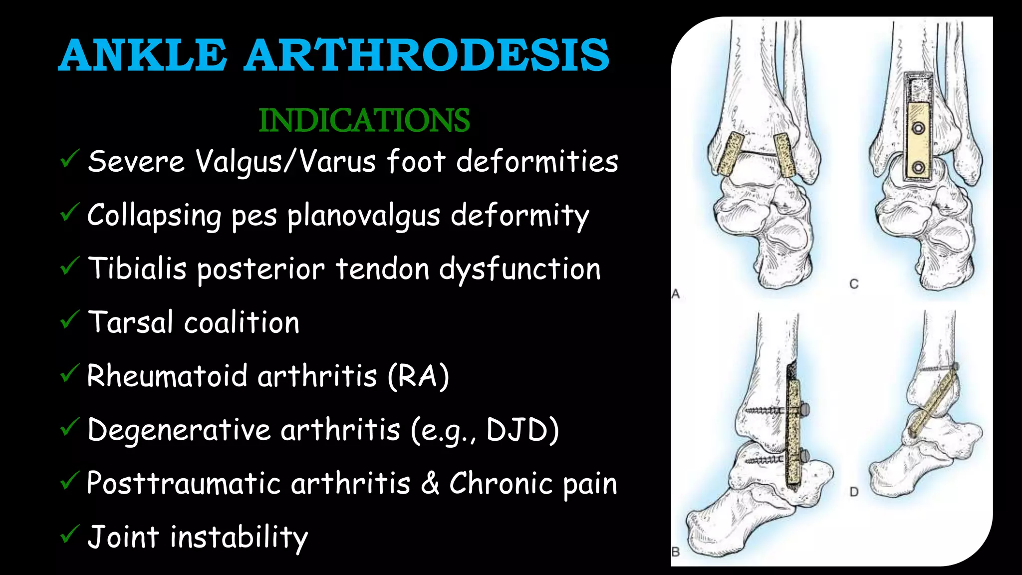 Arthrodesis indications & contraindications -PAWAN | PPTX