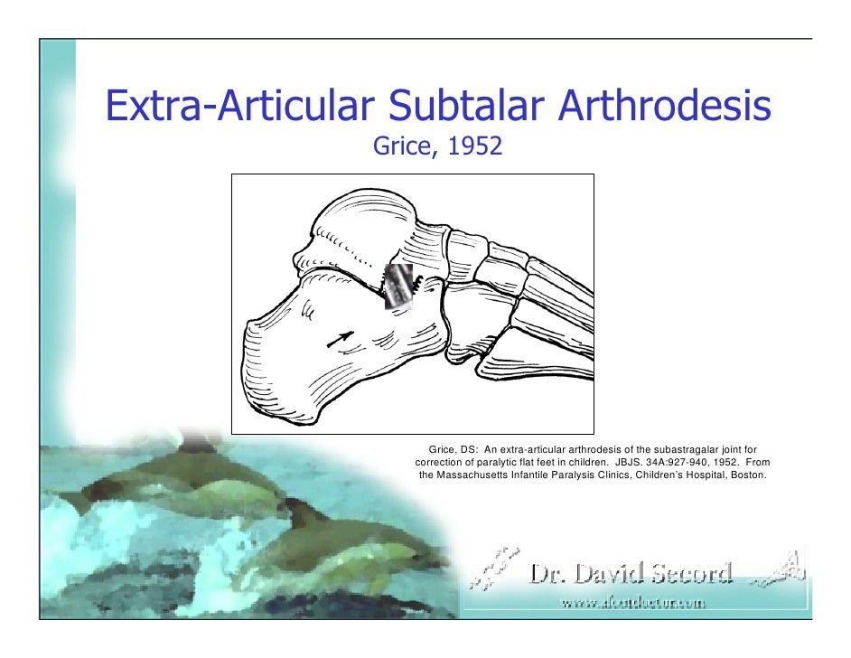 Arthroereisis Lecture