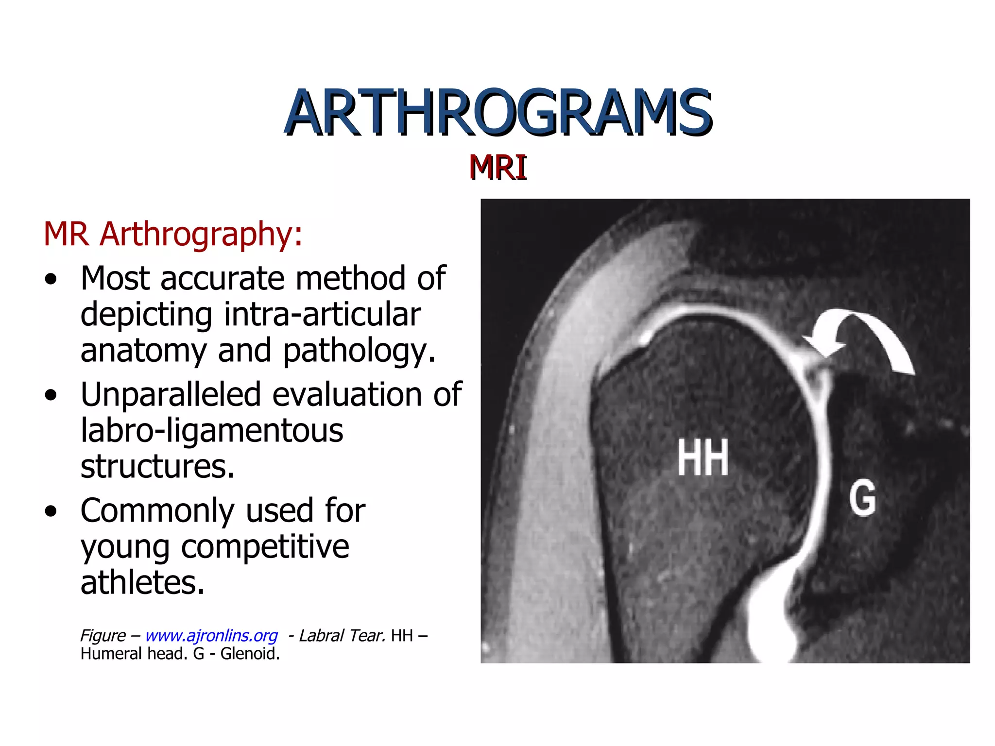 Arthrograms Presentation | PPT