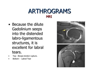 Arthrograms Presentation | PPT