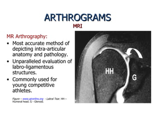 Arthrograms Presentation | PPT