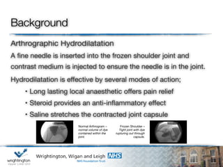 Arthrographic hydrodilatation for frozen shoulder | PDF