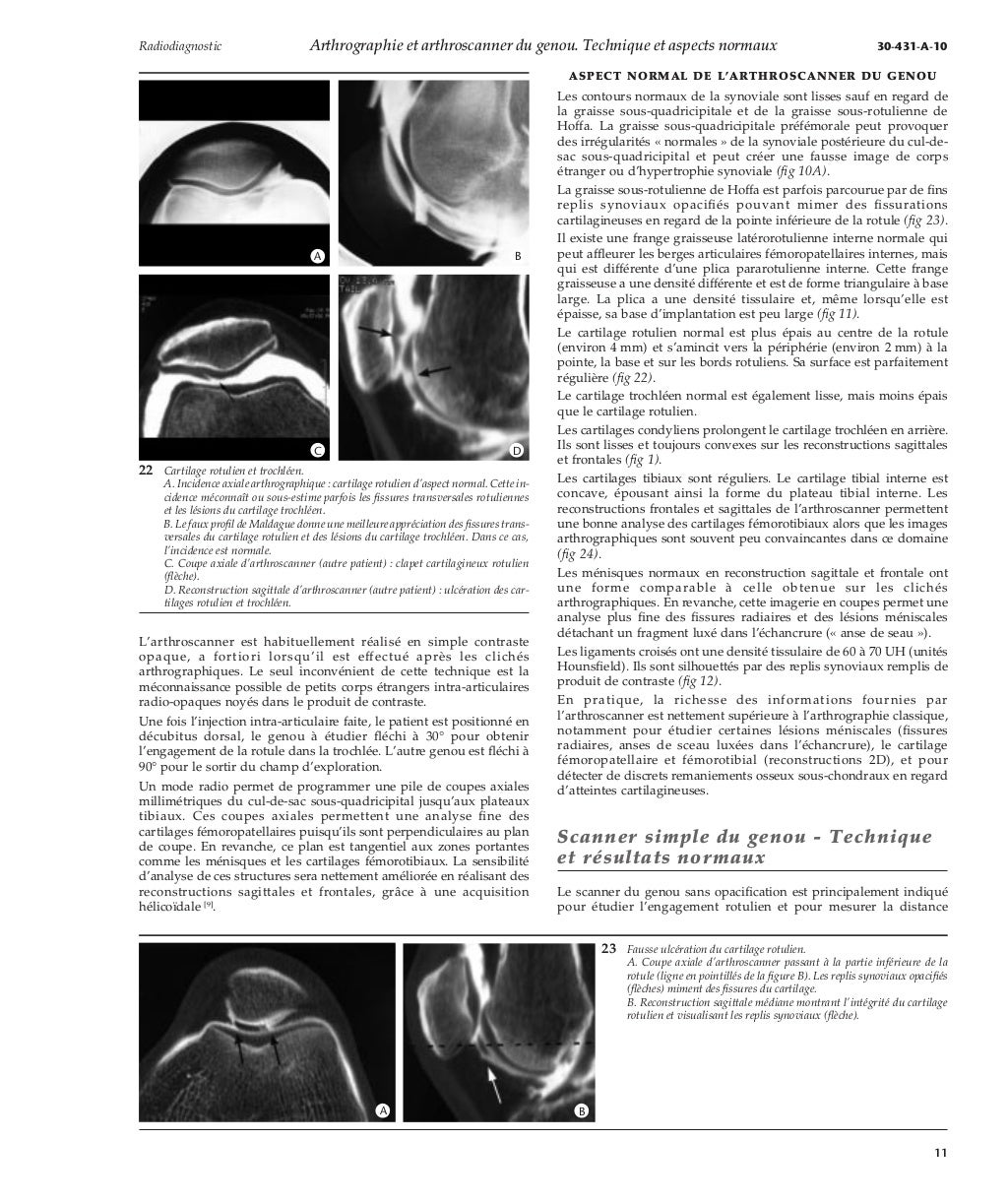 Arthrographie et arthroscanner du genou