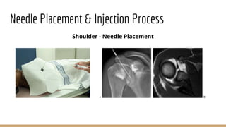 Arthrography of the Shoulder, Ankle and Wrist.pptx