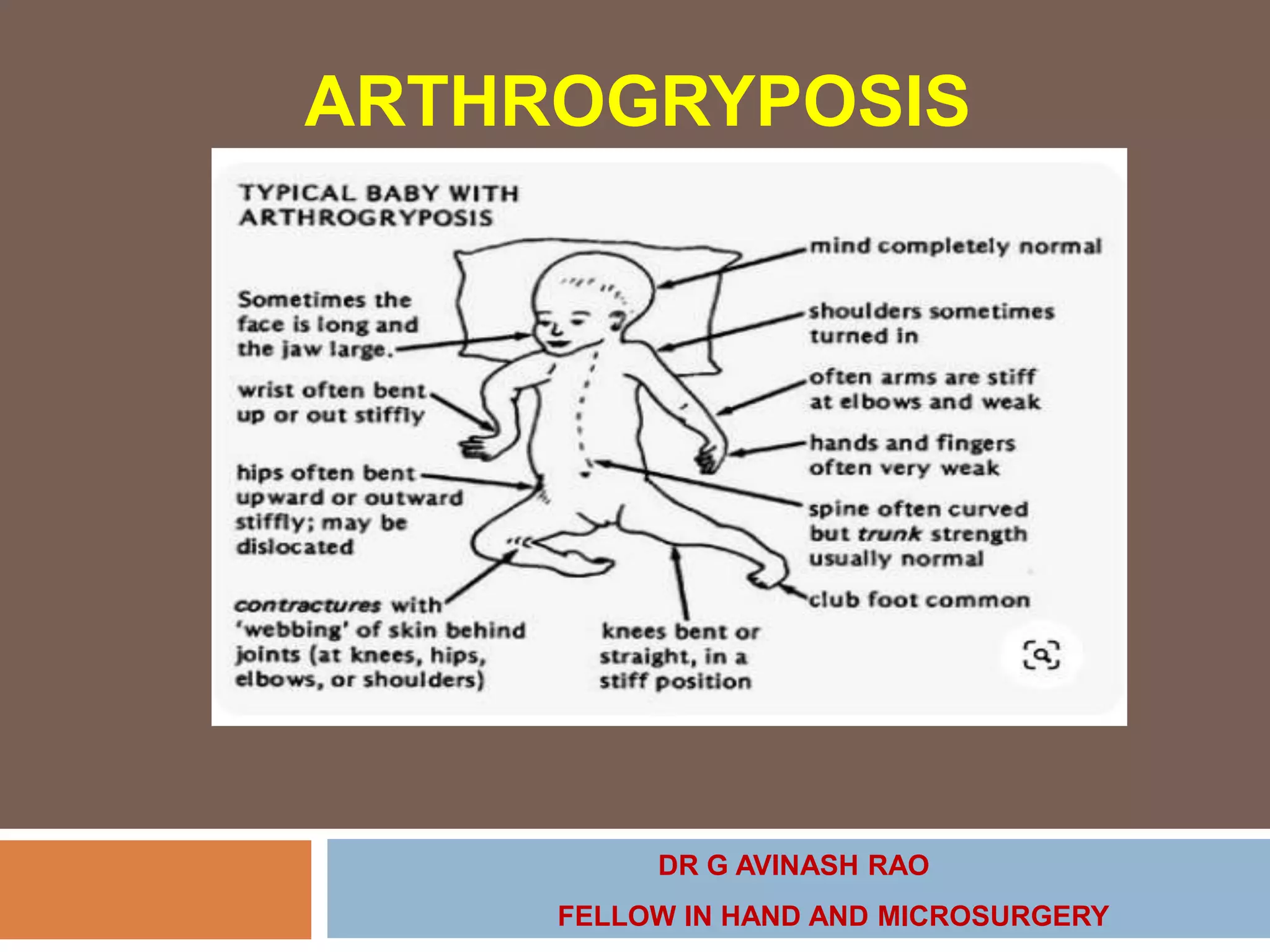 Arthrogryposis | PPTX