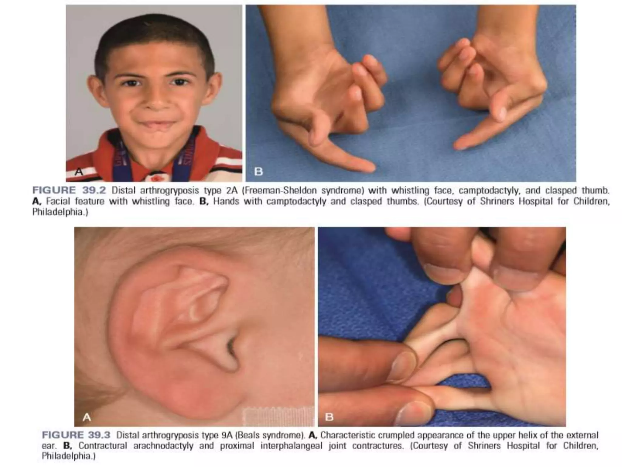 Arthrogryposis | PPTX