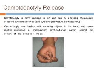 Arthrogryposis | PPTX