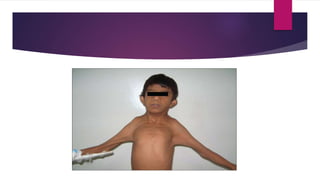 Arthrogryposis multiplex congenita | PPTX