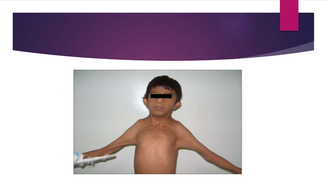 Arthrogryposis multiplex congenita