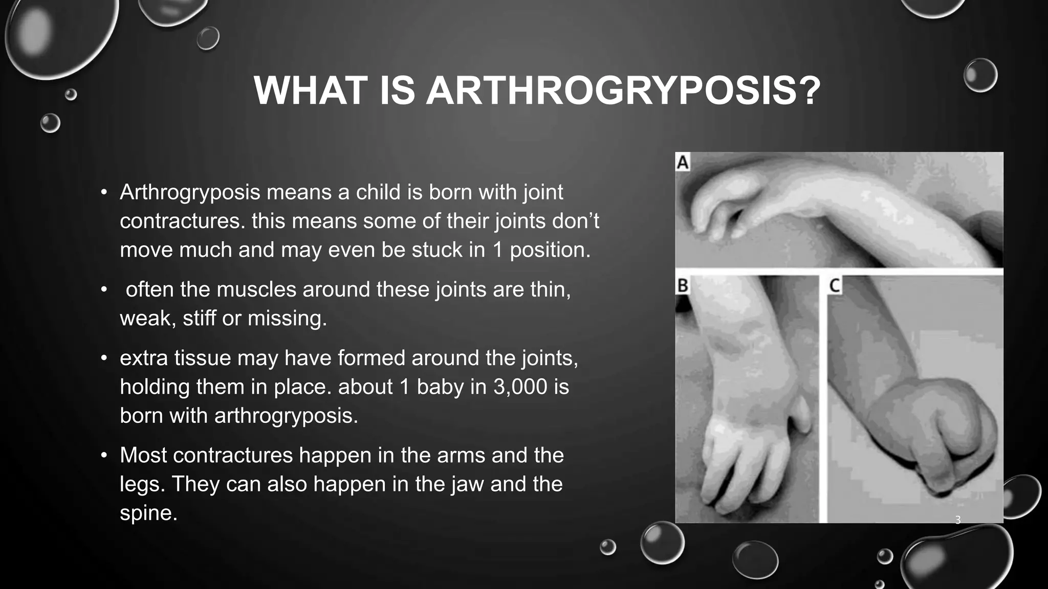 Arthrogryposis multiplex congenita | PPTX