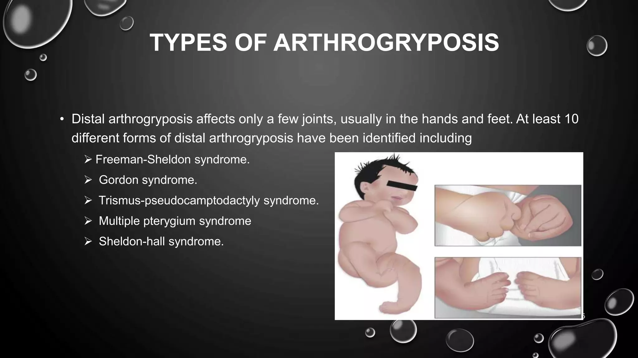 Arthrogryposis multiplex congenita | PPTX
