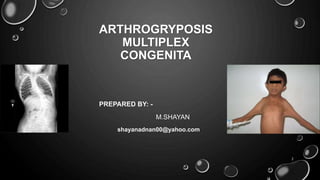 Arthrogryposis multiplex congenita | PPTX