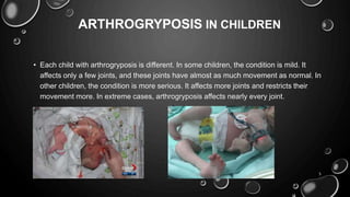 Arthrogryposis multiplex congenita | PPTX