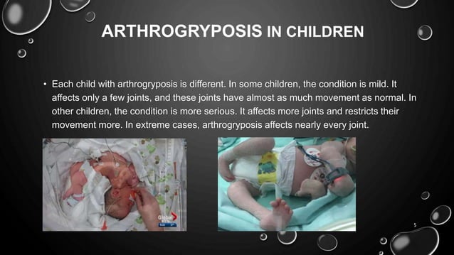 Arthrogryposis multiplex congenita | PPTX