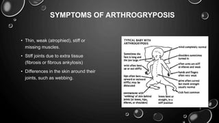 Arthrogryposis multiplex congenita | PPTX