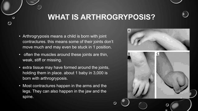 Arthrogryposis multiplex congenita