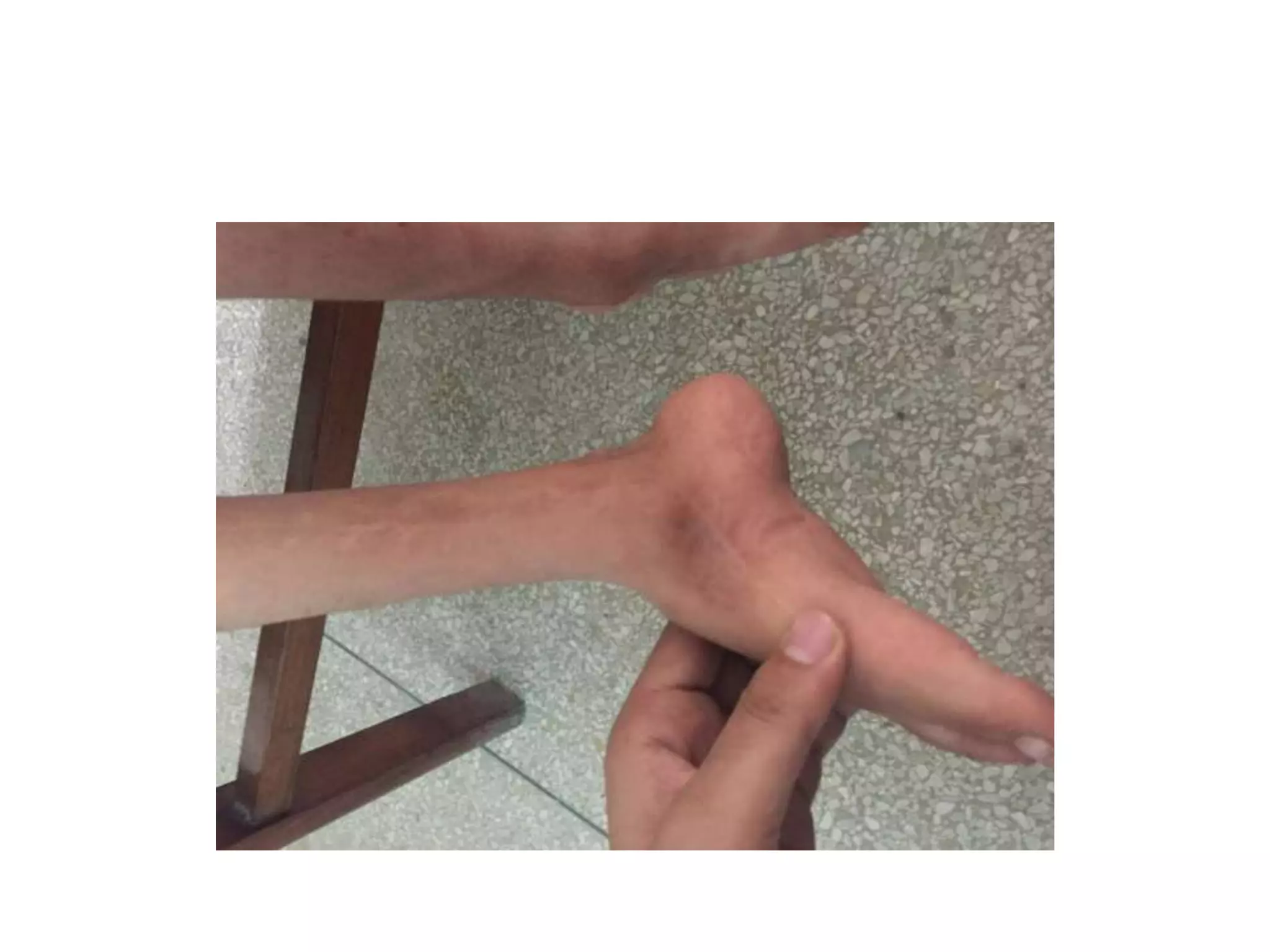 Arthrogryposis multiplex congenital congenital disorder | PPTX