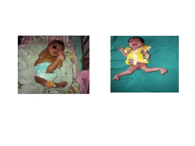 Arthrogryposis multiplex congenital congenital disorder | PPTX