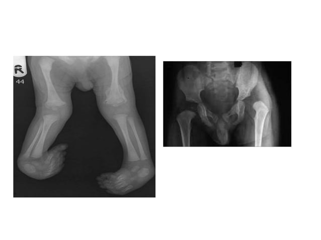 Arthrogryposis multiplex congenital congenital disorder