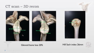 Arthrolatarjet (Arthroscopic Latarjet Proc) Dr Sujit Jos kerala | PDF