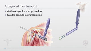 Arthrolatarjet (Arthroscopic Latarjet Proc) Dr Sujit Jos kerala | PDF