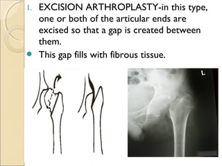 Arthroplasty | PPT