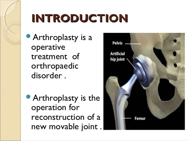 Arthroplasty