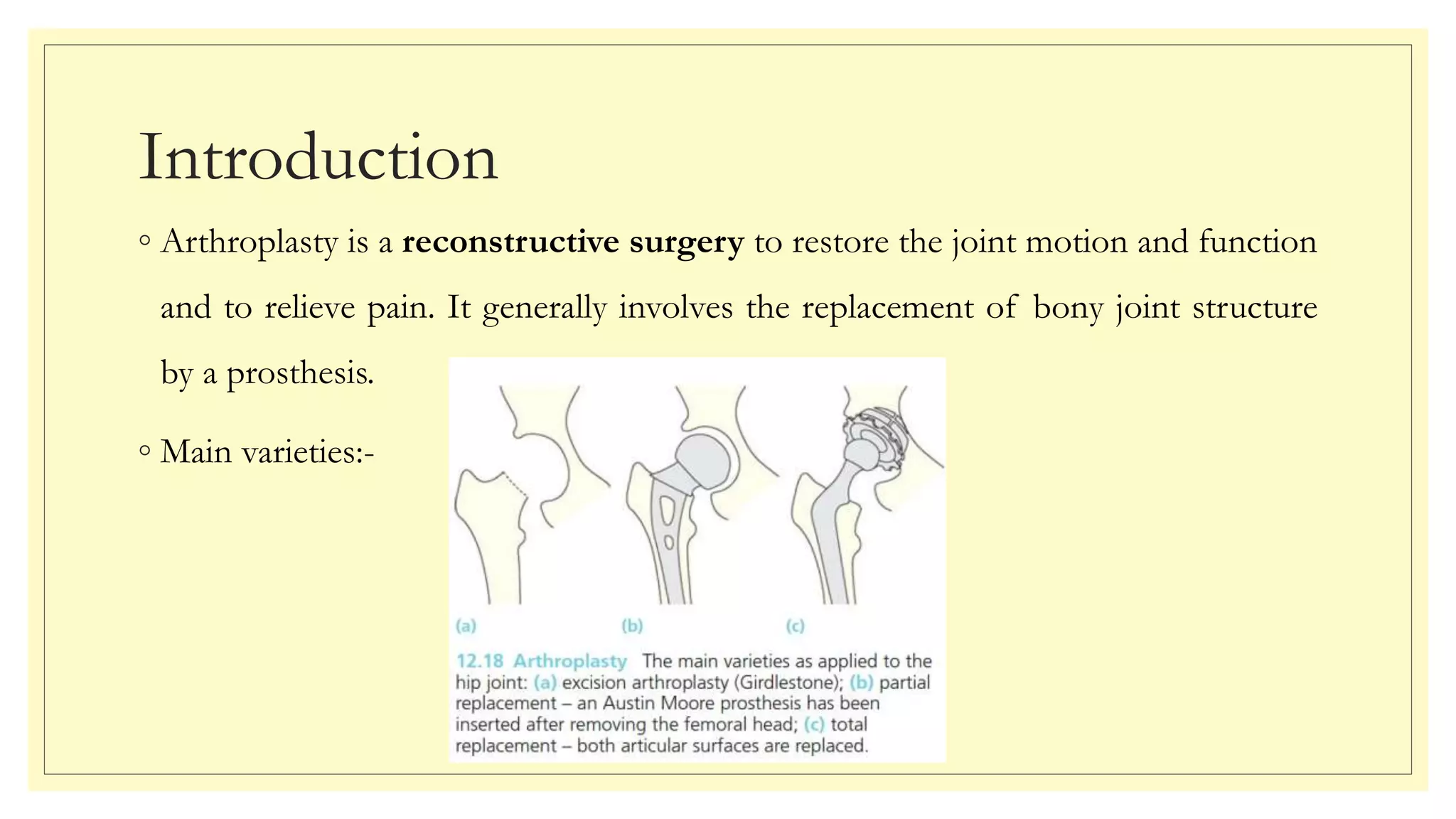 Arthroplasty | PPTX