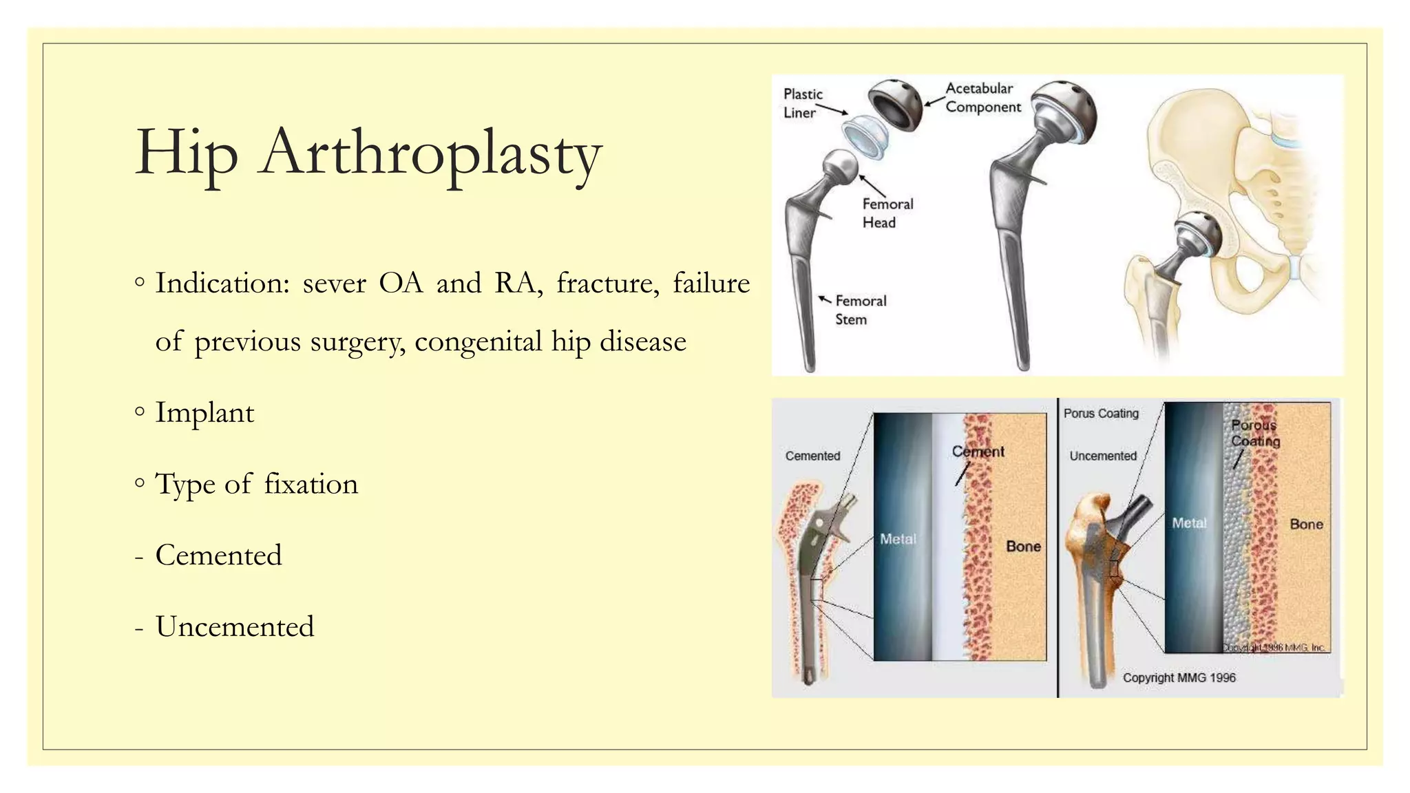 Arthroplasty | PPTX