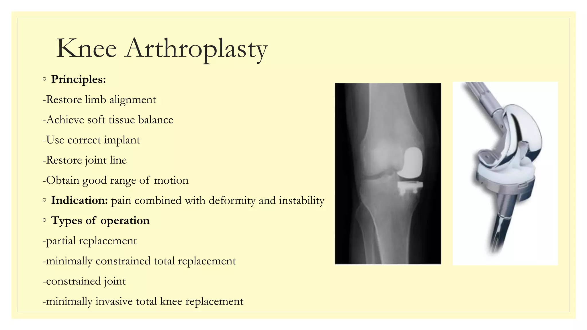Arthroplasty | PPTX
