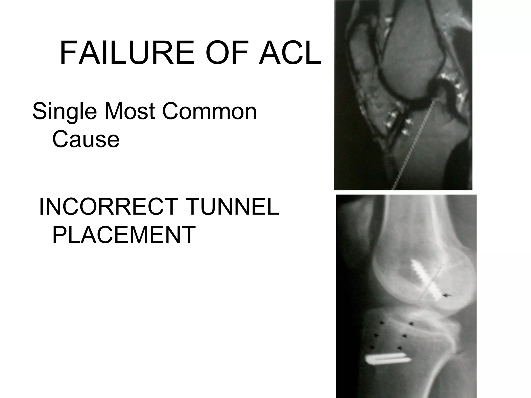 Arthroscopic ACL Reconstruction By Dr Shekhar Shrivastav | PDF