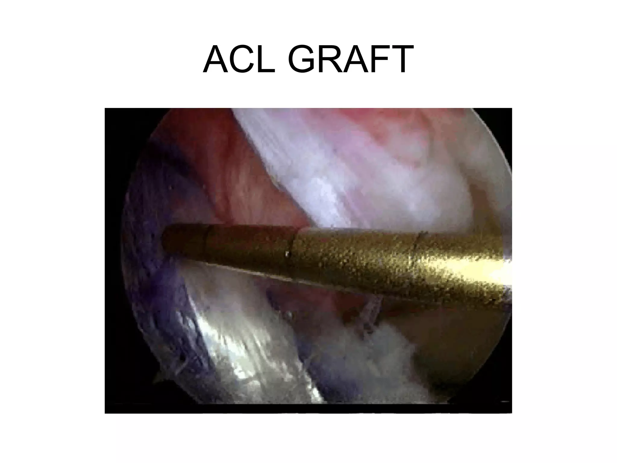 Arthroscopic ACL Reconstruction By Dr Shekhar Shrivastav | PDF