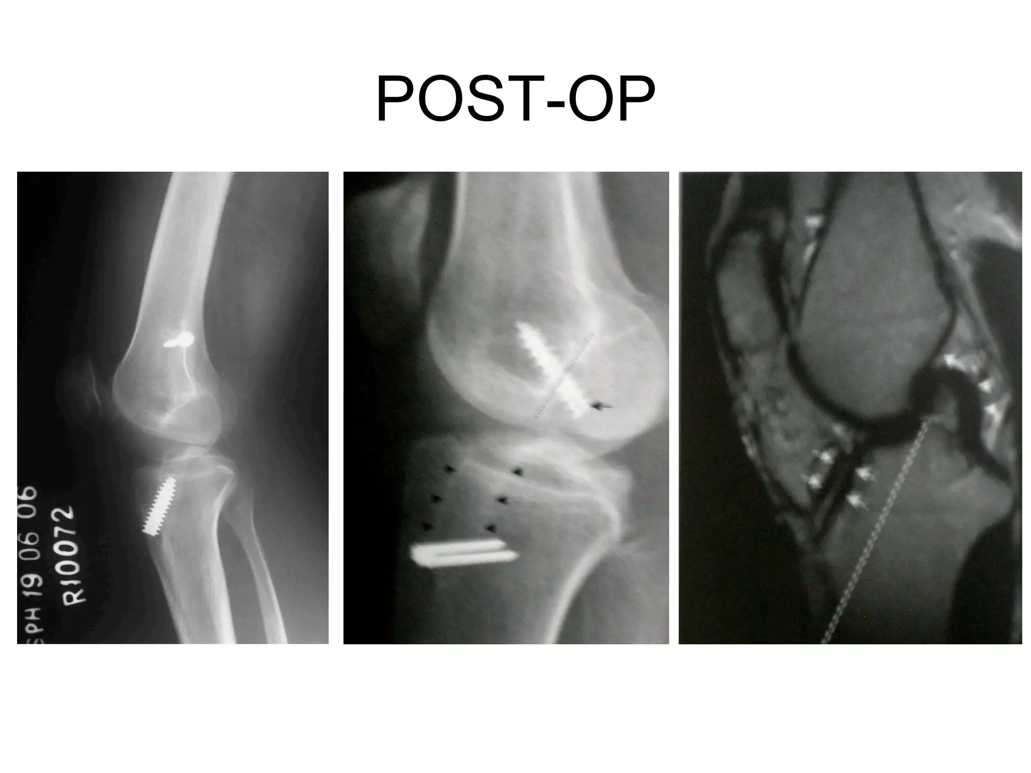 Arthroscopic ACL Reconstruction By Dr Shekhar Shrivastav | PDF