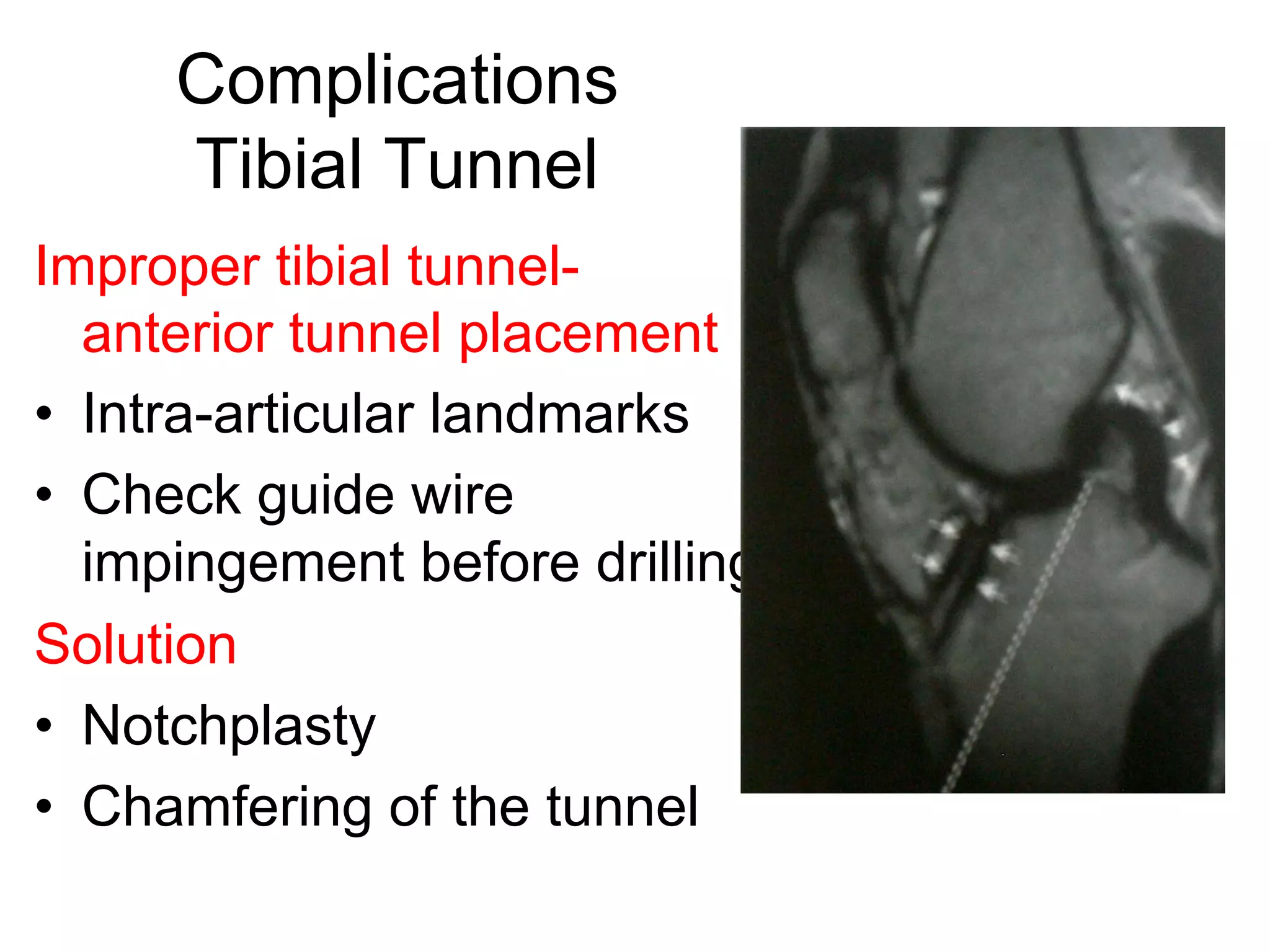 Arthroscopic ACL Reconstruction By Dr Shekhar Shrivastav | PDF