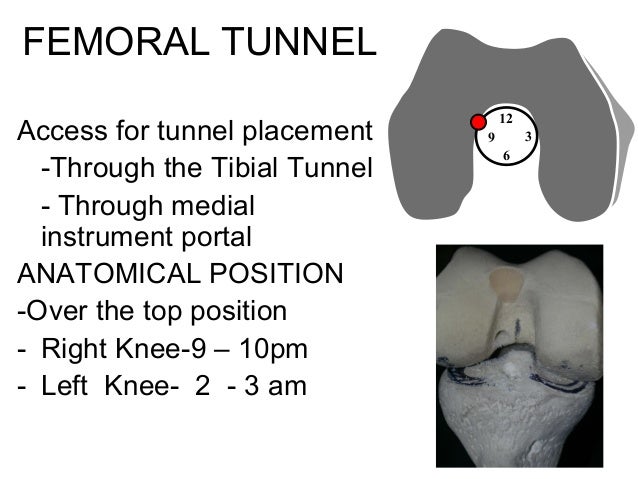 Arthroscopic ACL Reconstruction By Dr Shekhar Shrivastav