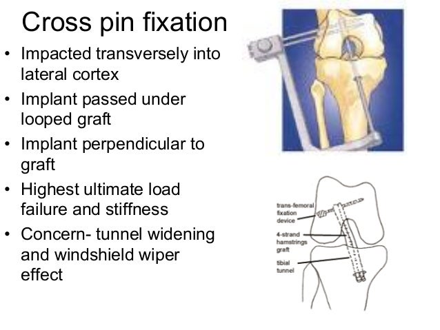 Arthroscopic ACL Reconstruction By Dr Shekhar Shrivastav