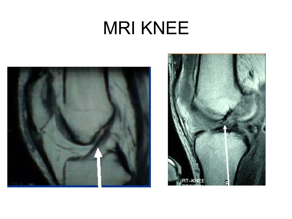Arthroscopic ACL Reconstruction By Dr Shekhar Shrivastav