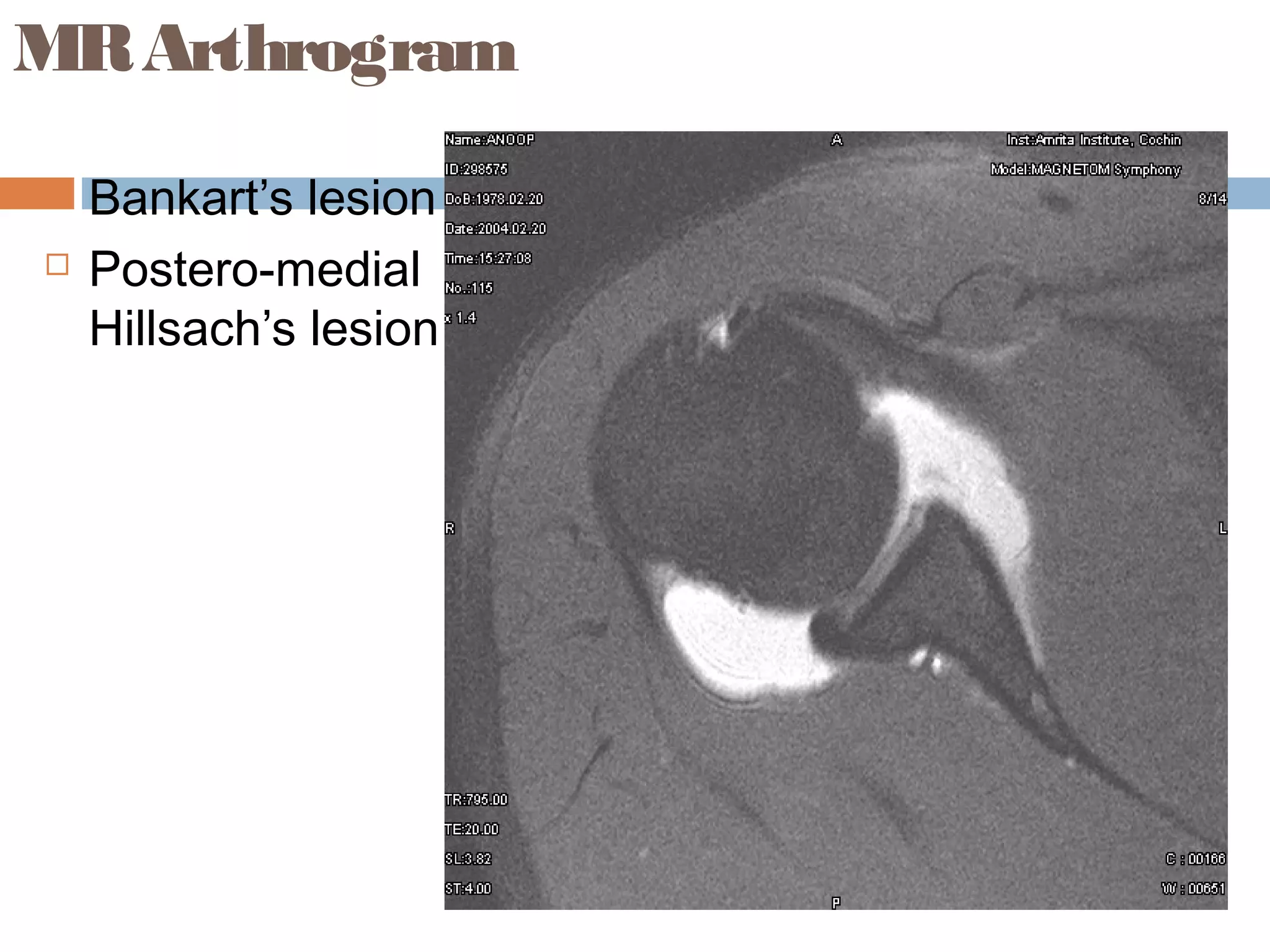 Arthroscopic bankart’s repair | PPT