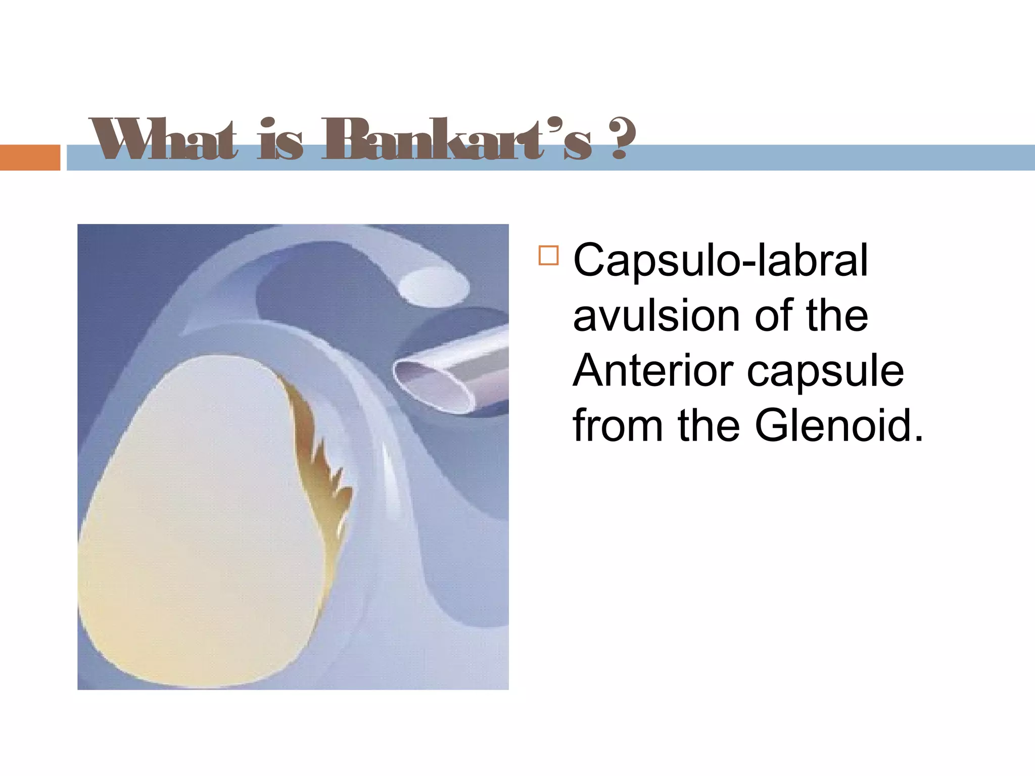 Arthroscopic bankart’s repair | PPT