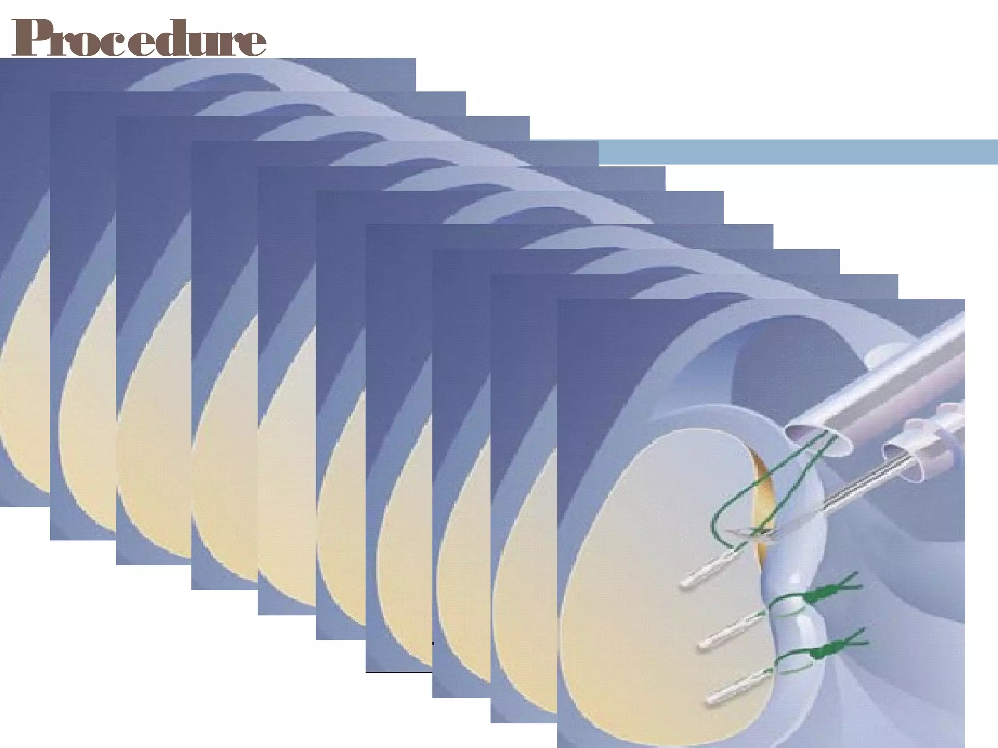 Arthroscopic bankart’s repair | PPT