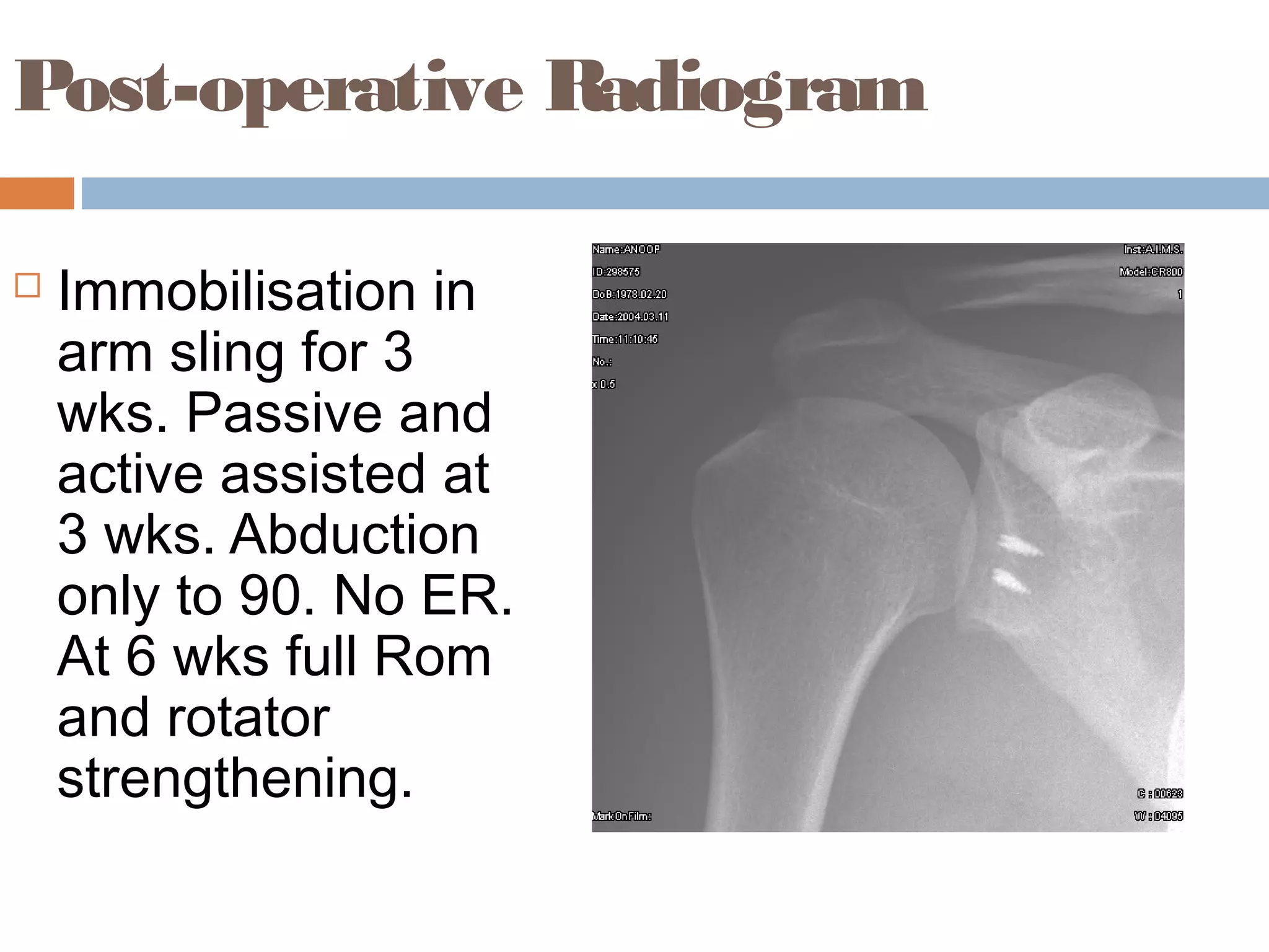 Arthroscopic bankart’s repair | PPT