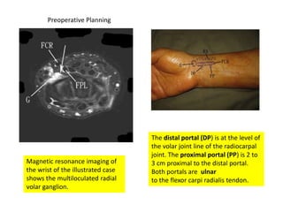 Arthroscopic excision of gnglion cyst | PPT
