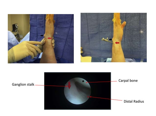 Arthroscopic excision of gnglion cyst | PPT