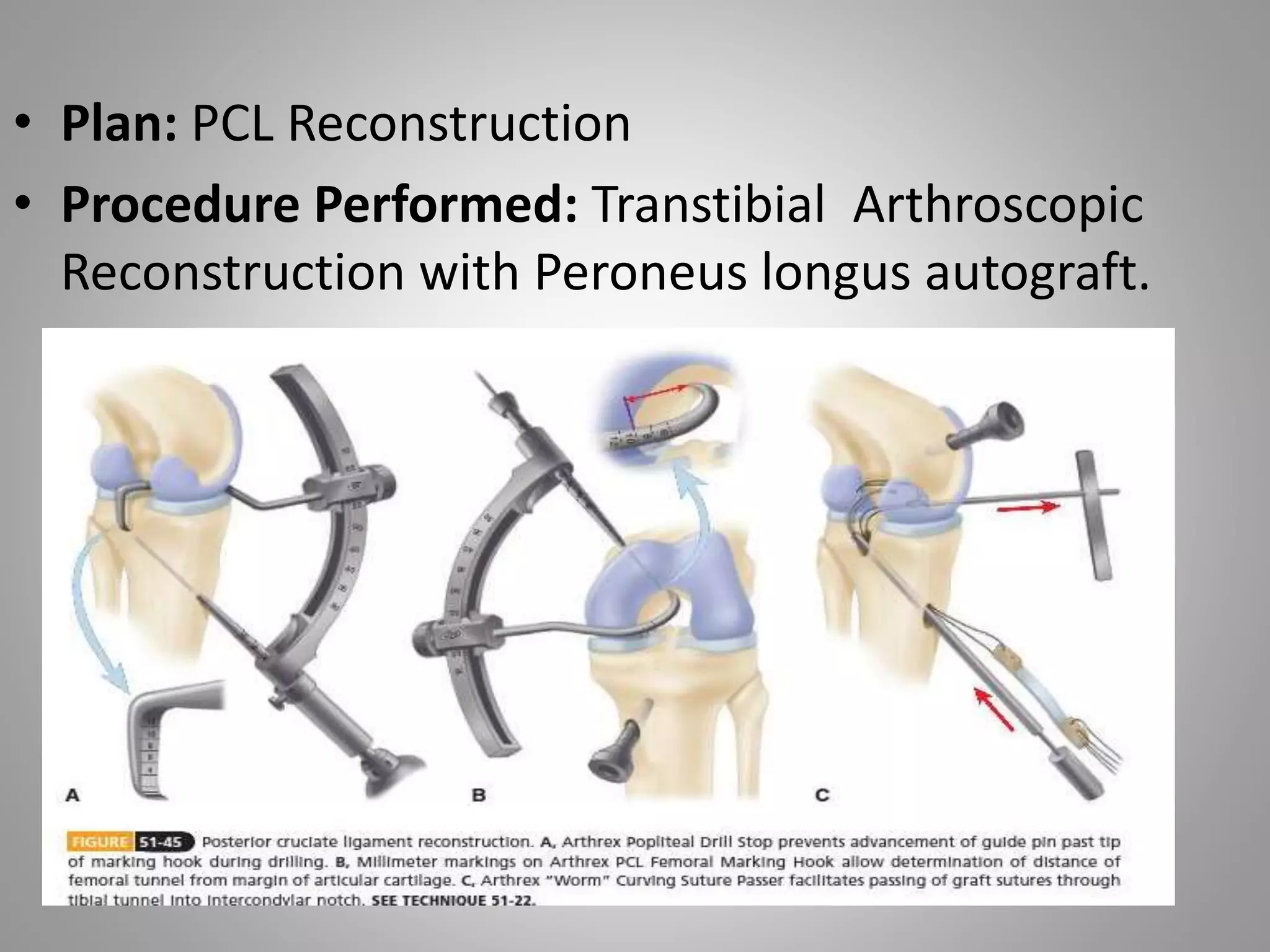 Arthroscopic pcl reconstruction | PPTX