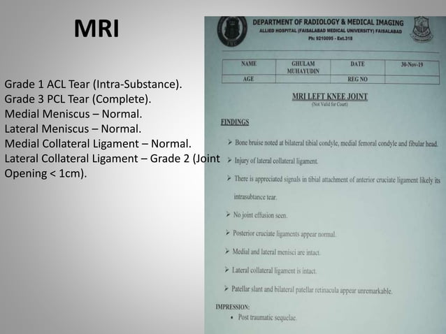 Arthroscopic pcl reconstruction | PPTX