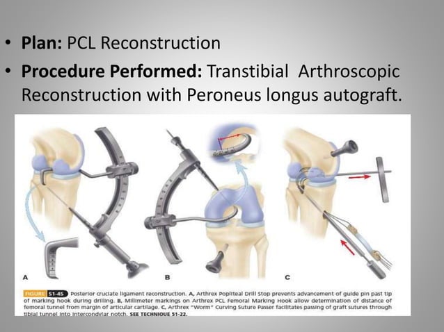 Arthroscopic pcl reconstruction | PPTX
