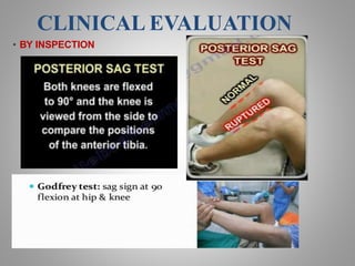 Posterior Sag Test 90 90