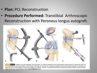 Arthroscopic pcl reconstruction | PPT