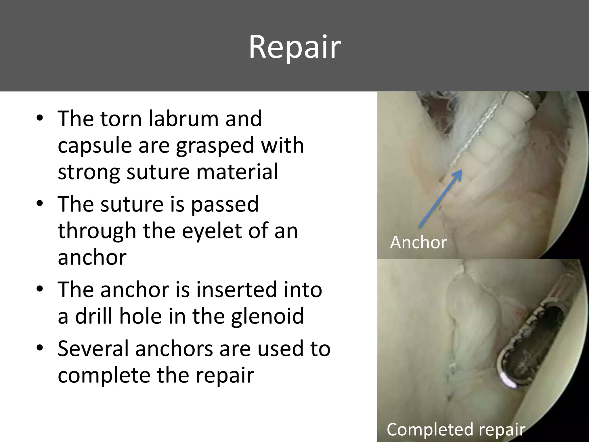 Arthroscopic shoulder stabilisation patient information | PPTX