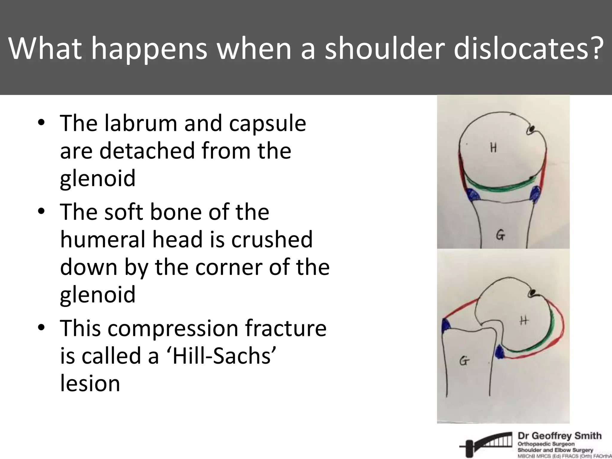 Arthroscopic shoulder stabilisation patient information | PPTX